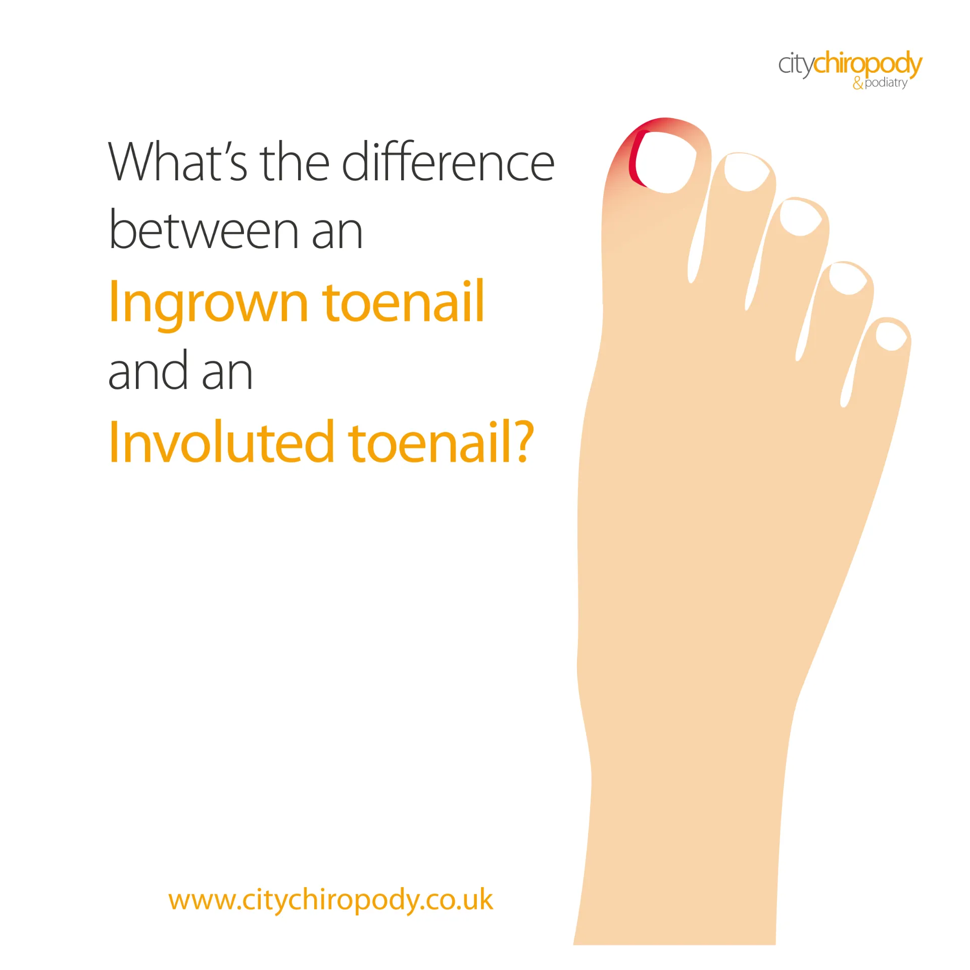 Ingrown Toenail V Involuted Toenail - City Chiropody